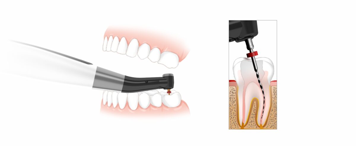 EndoMatic | Paytekht Company